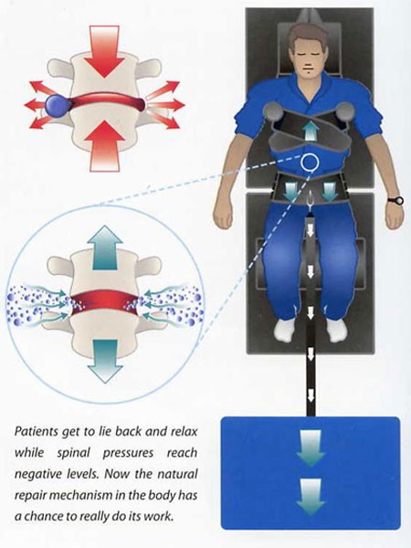 Spinal Decompression in Fort Lauderdale - Chiropractic Care of Fort ...