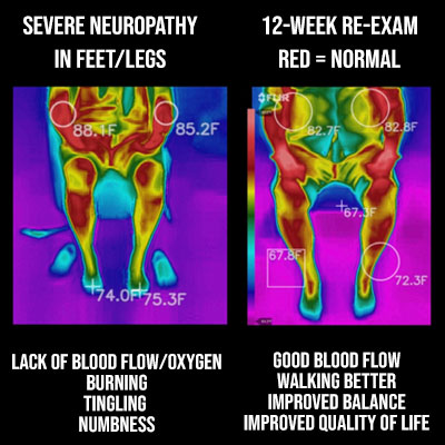 Peripheral Neuropathy - Genesis Physical Medicine and Chiropractic ...